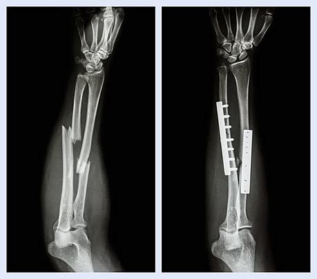 Forearm Fracture Fixed With Plates And Screws Before And After Images Photo Background And