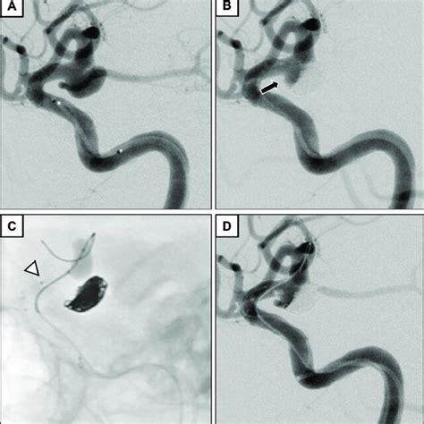 Right Internal Carotid Angiography Showing An Unruptured Intracranial Download Scientific