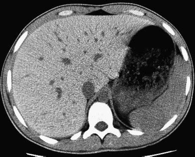 Diffuse Liver Disease Radiology Key