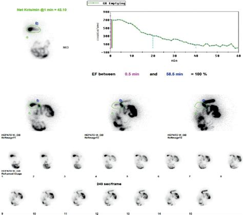 Understanding Hida Scan Results