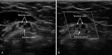Ultrasonography For Deep Venous Thrombosis Clinical Gateclinical Gate