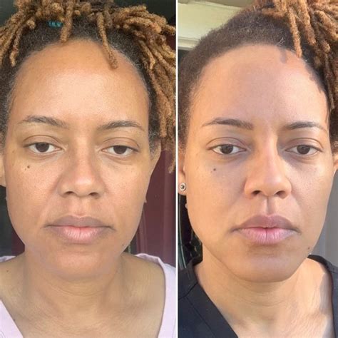 Glow With Pdo Afterglo Treatment At Better Life Clinics