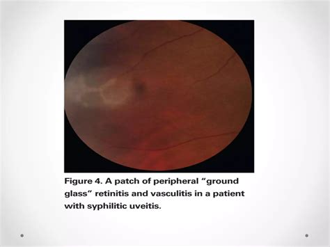 Interstitial Keratitis Pptx Interstitial Keratitis Pptx