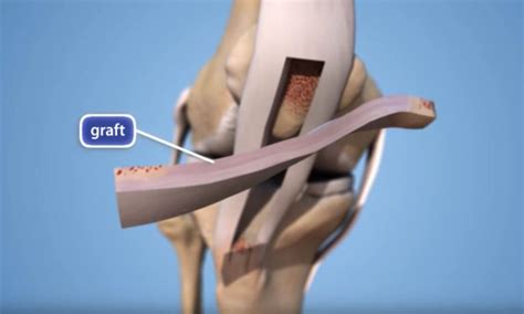 ACL Reconstruction Animation OrthoInfo AAOS