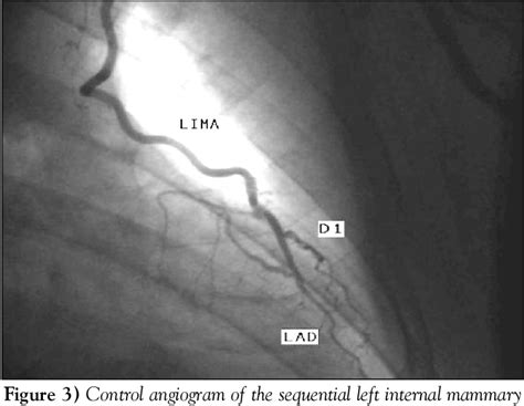 Figure 3 From Totally Endoscopic Sequential Arterial Coronary Artery
