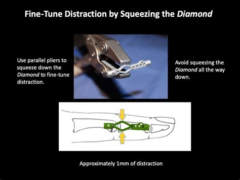 Distraction Methods Archives Virak Orthopedics