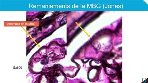 Mediapod Introduction À La Néphropathologie Bertran…