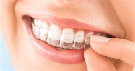 Modern Ways To Align Your Teeth Dr Smile
