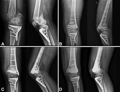 A D A A Preoperative Radiograph Shows Ota C Type Fracture With