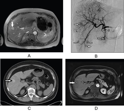 Transarterial Chemoembolization Tace As A Palliative Treatment Option