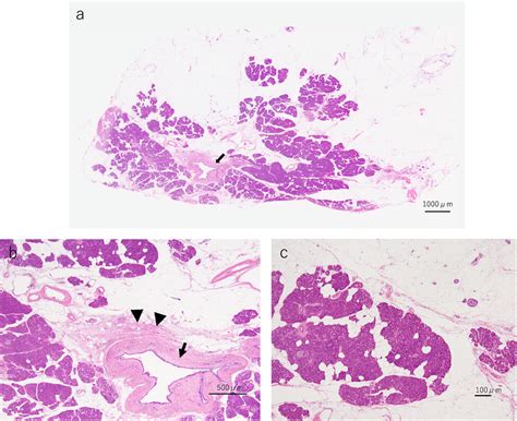 Histopathology Of Diffuse Parenchymal Atroph Dpa A 71‐year‐old Woman Download Scientific