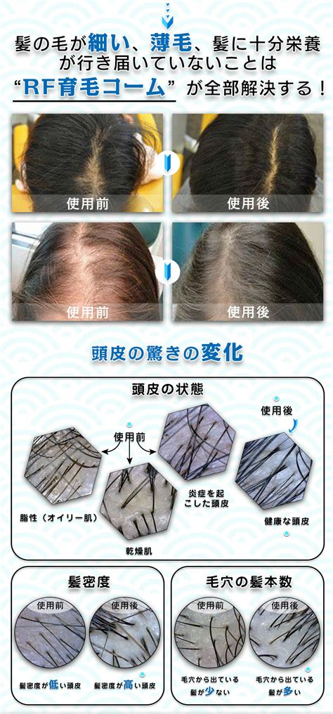 【楽天市場】頭皮ケア ヘッドケア ヘッドスパ Rf頭皮ブラシ 電動頭皮ブラシ スカルプケア ヘアケア 美髪 美顔器 Ems エレクトロポレーション 頭皮 薄毛対策 男女兼用 プレゼント