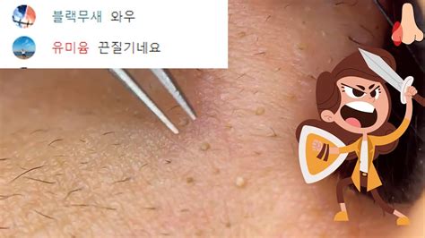 피지제거 끈질긴 녀석 내가 상대해주마 YouTube