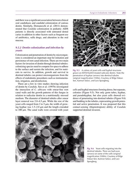 Fungi In Endodontic Infections Pdf Dental Health Diseases And Conditions