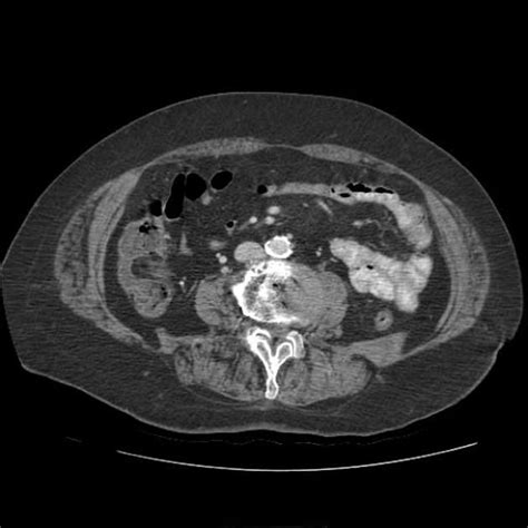 Lipomatosis Of The Ileocecal Valve Radiology Reference Article