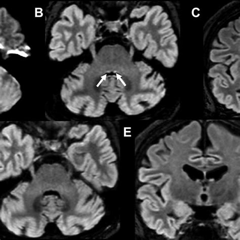 Diffusion Weighted Image Dwi And Flair Images On Brain Mri A Dwi