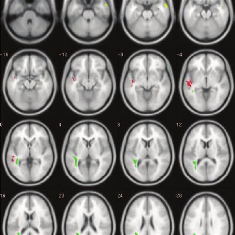 Significant Clusters Of Relatively Decreased Gray Matter Volume