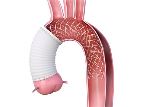 Amds™ Hybrid Prosthesis Artivion