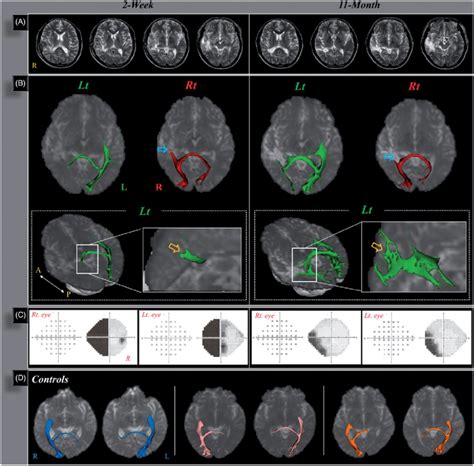 A T2 Weighted Brain Mr Images Taken At 2 Weeks And 11 Months After