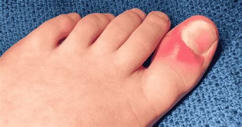 Toe Infection Symptoms