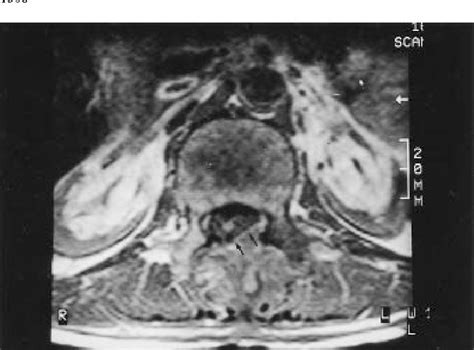 Figure 4 From Pyoderma Gangrenosum And Spinal Epidural Abscess After