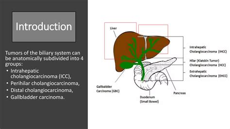 Intrahepatic Cholangiocarcinoma Ppt
