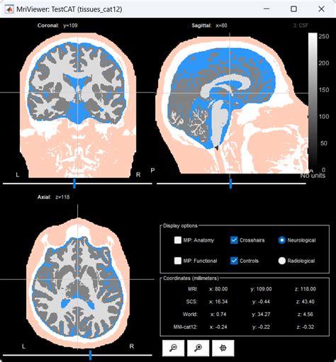 CAT12 Tissue Segmentation Error Bugs Brainstorm