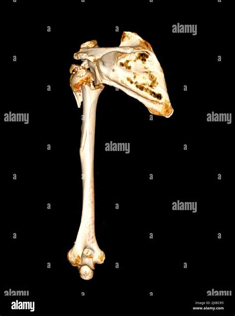 Computed Tomography Volume Rendering Examination Of The Shoulder Joint And Humerus Bone 3d