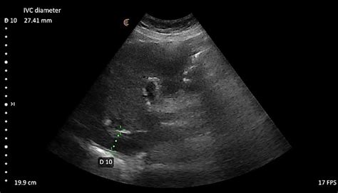 Measurement Of Ivc Diameter On Abdominal Ultrasound Download