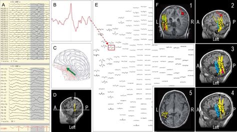 A E An Example Of An Individual Simultaneous Meg Eeg Discharge In The