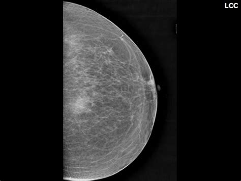 Atlas Of Breast Cancer Early Detection