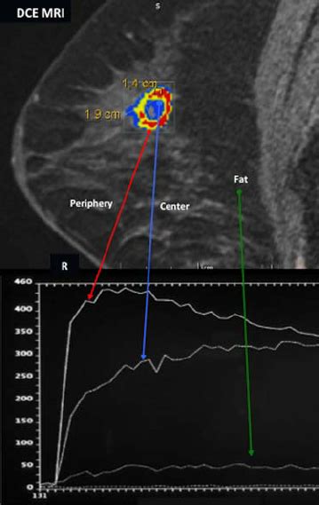Qualitative Analysis Of The Shape Of Signal Intensity Time Curve In A Download Scientific