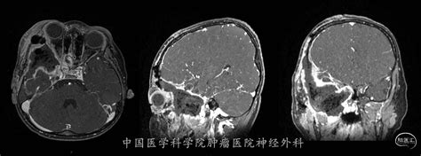 中国医学科学院肿瘤医院万经海教授：经眶颧入路切除儿童颅底骨纤维化瘤1例 脑医汇
