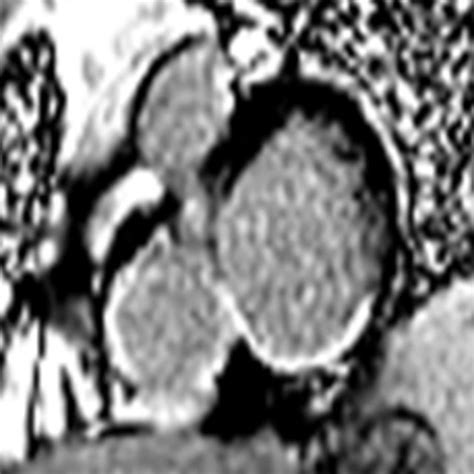 Short Axis Slice Of Right Ventricular Stress Induced Perfusion Defect Download Scientific Diagram