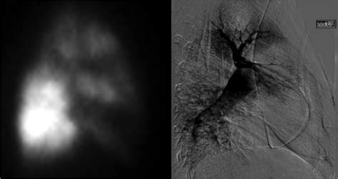 Pulmonary Embolus NucsRadiology Com