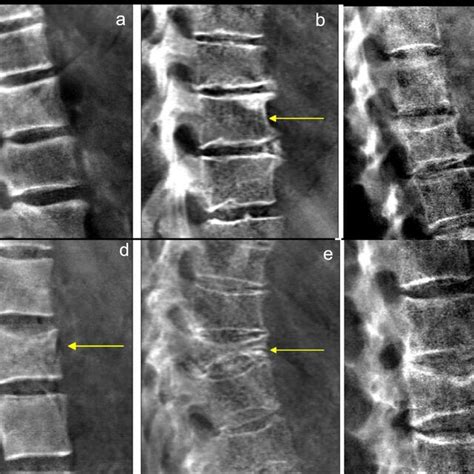 The Five Reference Points One On Each Corner And The Fifth On Bra