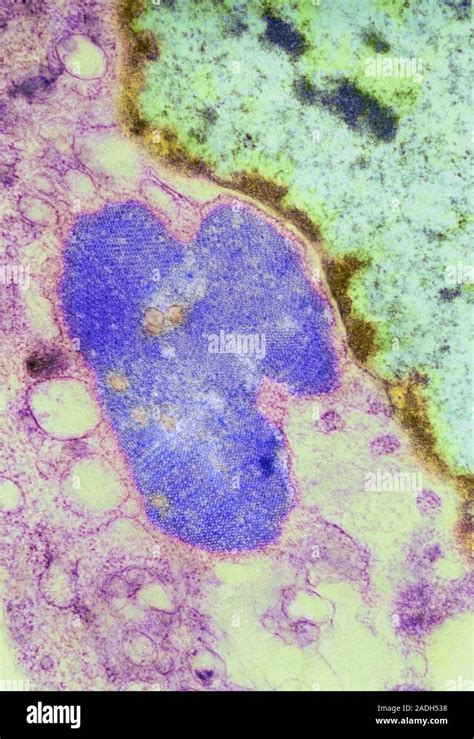 Dengue Fever Virus Replication Coloured Transmission Electron Micrograph TEM Of Dengue Fever