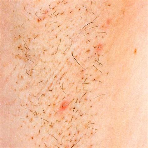 Ingrown Armpit Hairs Effective Remedies Most Skincare
