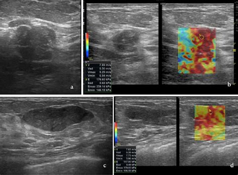 A Brightness B Mode Ultrasonography Us Image Of A 51 Year Old