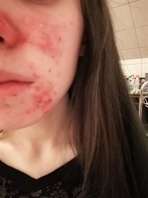 Before And After Doxycycline Treatment R Acne