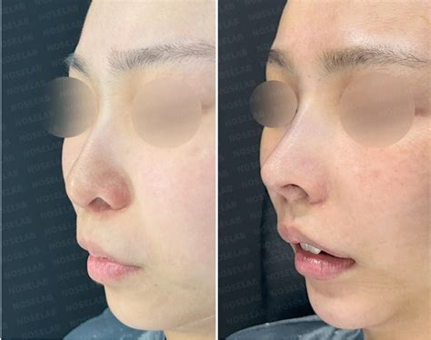 Closed Rhinoplasty Korea Improving Low Nose And Facial Balance