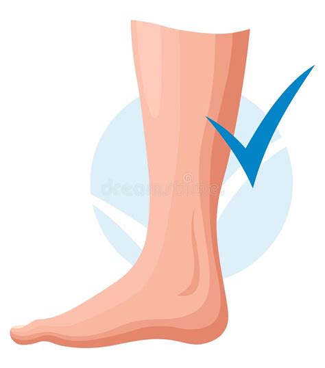 Stages Or Types Of Varicose Veins Development Medical Poster Or