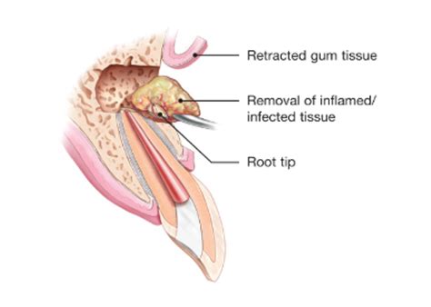 Endodontic Microsurgery In Pittsburgh Soft Touch Endodontics