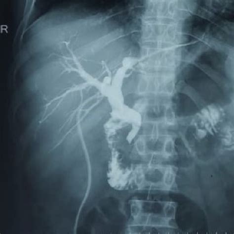 T Tube Cholangiogram Showing Patent Biliary Tree Download Scientific