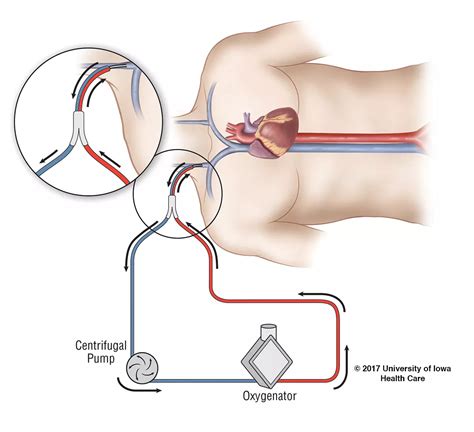 vv ecmo cannula placement
