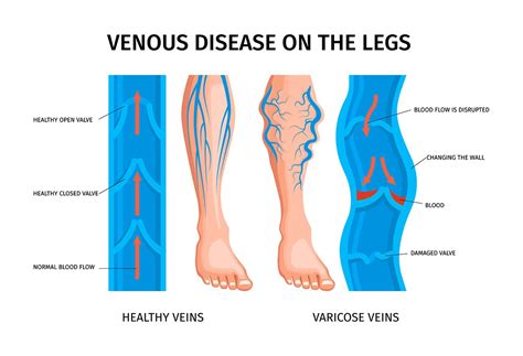 Understanding Varicose Veins Causes Symptoms And Advanced Treatments