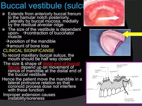 Significance Of Maxillary Denture Bearing Area Pptx