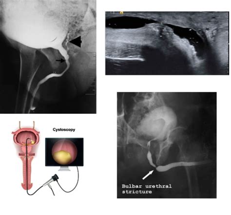 Bladder Disorders Flashcards Quizlet