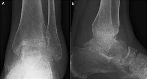 Running After Ankle Microfracture Surgery At Anthony Gregory Blog