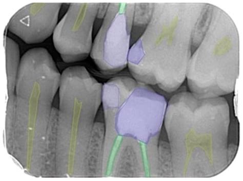 What Is The Difference Between A Bite Wing And A Periapical Image At